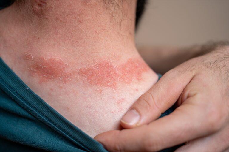 Understanding Dermatitis: Signs & Symptoms – OnSix.co